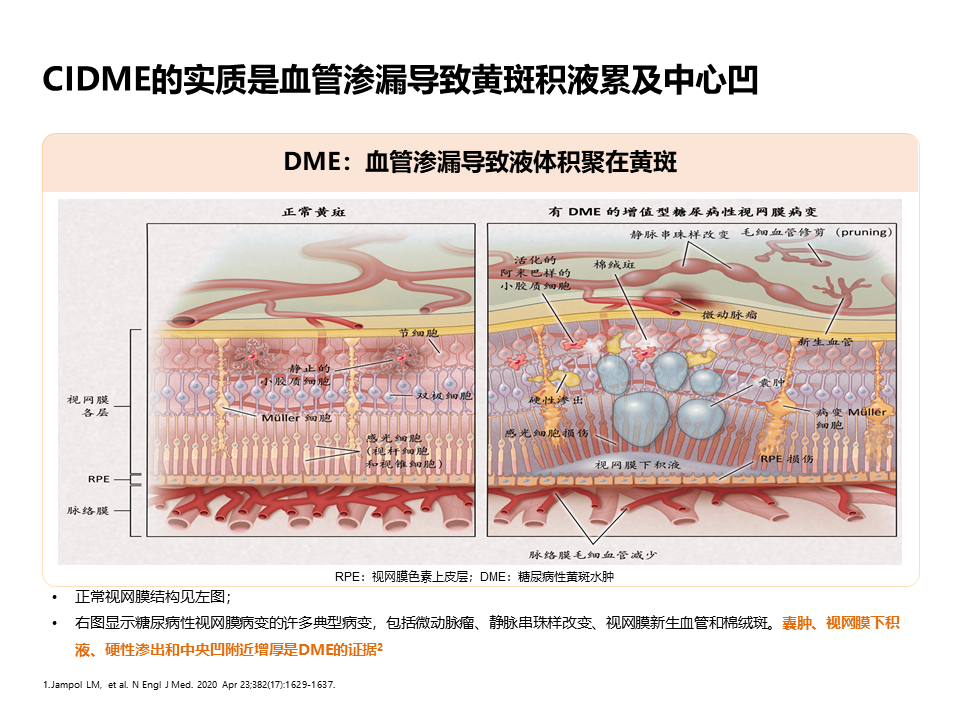 认识DME疾病-京东健康